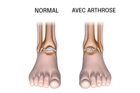 Arthrose de la cheville - Chirurgien orthopédique à Paris