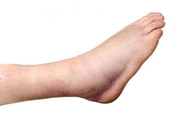 Fracture de la cheville - Chirurgien orthopédique à Paris